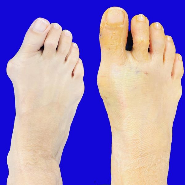 Northwest Surgery Center | Minimally Invasive Foot Surgery