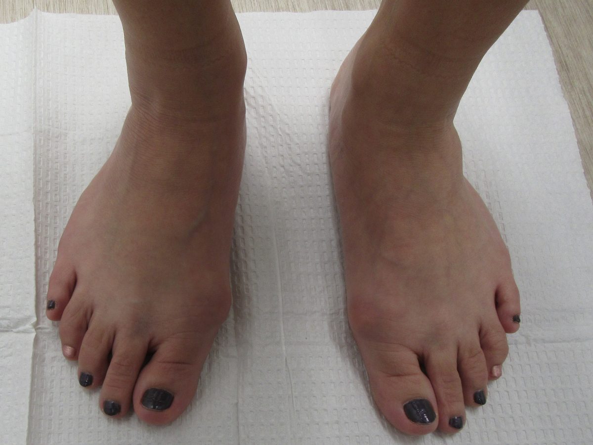 Bunions - What You Need To Know | The Bunion Cure