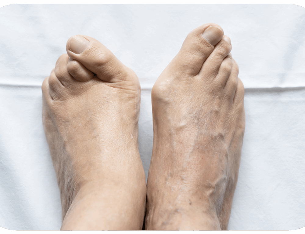 Minimally Invasive Hammertoe Surgery | The Bunion Cure