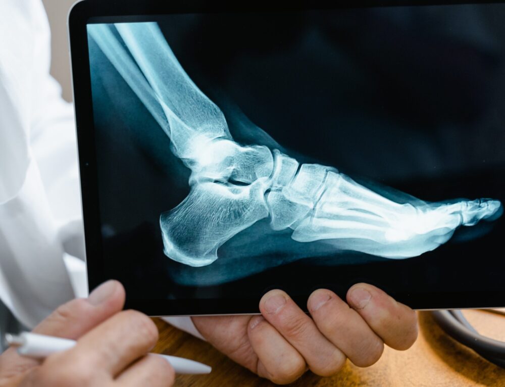 How Do You Fix a Hammertoe? | The Bunion Cure